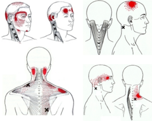 Triggerpoint-therapie – Jadai